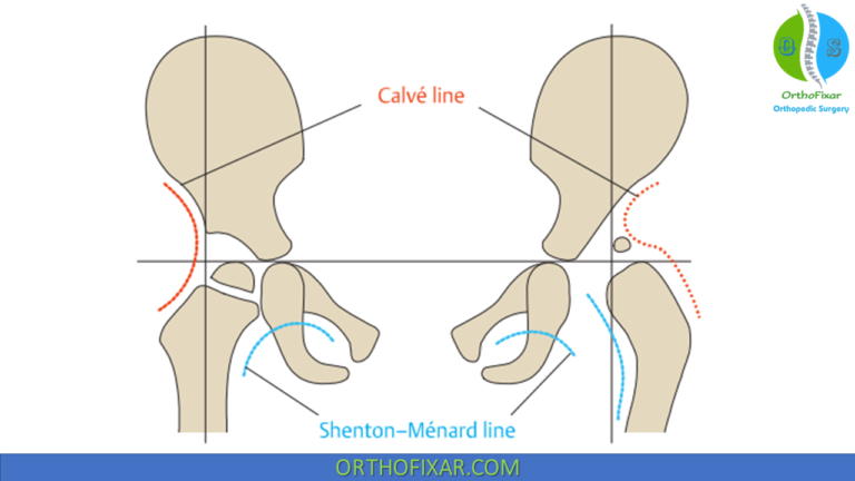 DDH Radiology Explained Easily | OrthoFixar