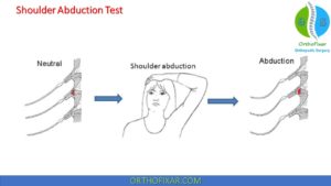 Shoulder Abduction Test (Bakody Sign) | 2025