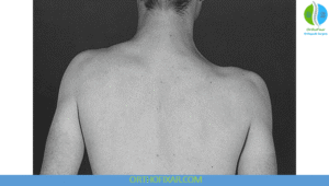 Spinal Accessory Nerve Injury | OrthoFixar