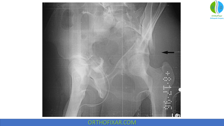 Acetabulum Fracture Full Explained | OrthoFixar 2025