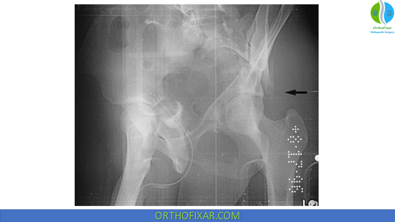 Acetabulum Fracture Full Explained | OrthoFixar 2025