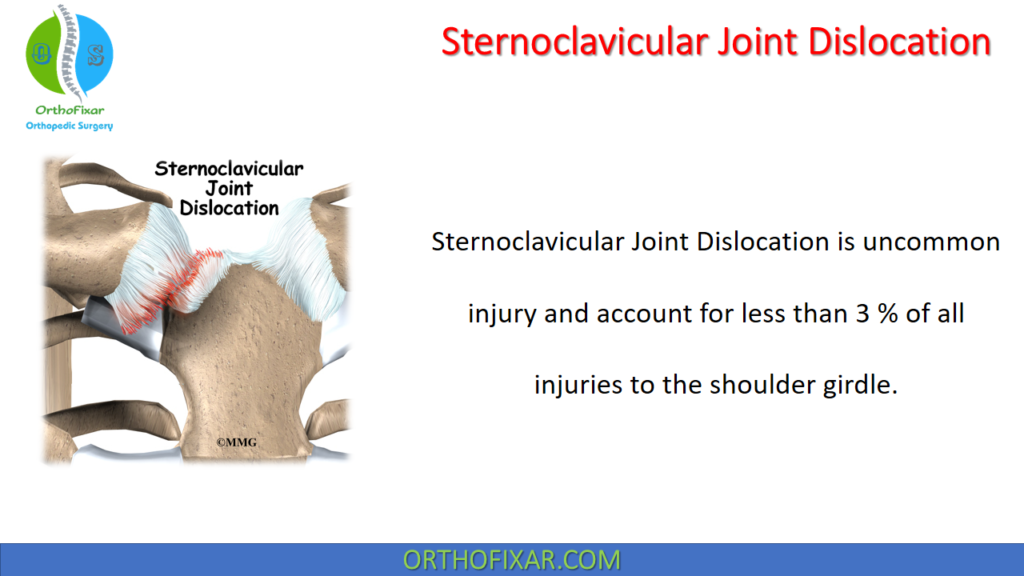 Sternoclavicular Joint Dislocation | OrthoFixar