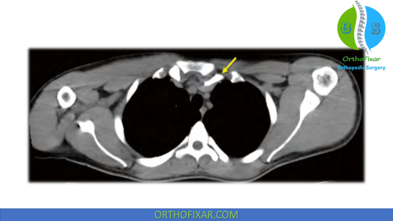 Sternoclavicular Joint Dislocation | OrthoFixar
