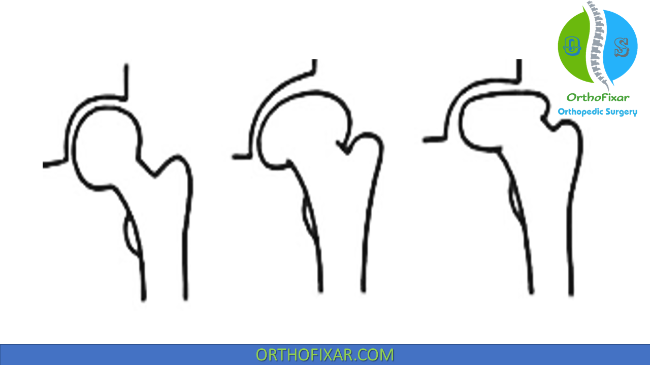 Legg-Calvé-Perthes Disease | OrthoFixar 2025