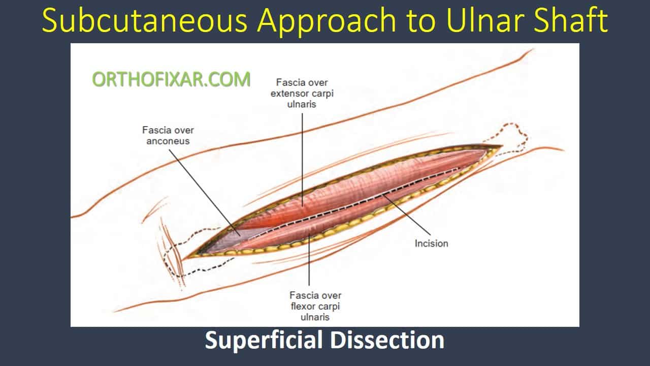 Subcutaneous Approach To Ulnar Shaft Easily Explained | OrthoFixar