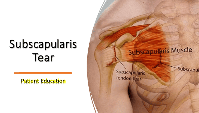 Subscapularis Strengthening
