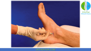 Subtalar Joint Injection Easily Step-By-Step | OrthoFixar