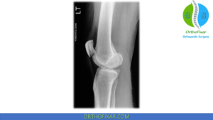 Patellar Dislocation | Orthopedic Learning