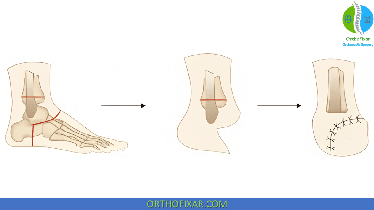 Syme Amputation & Prosthesis Easily Step-By-Step | OrthoFixar
