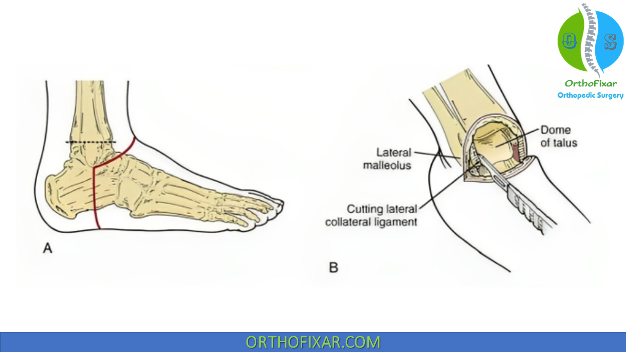 Syme Amputation & Prosthesis Easily Step-By-Step | OrthoFixar