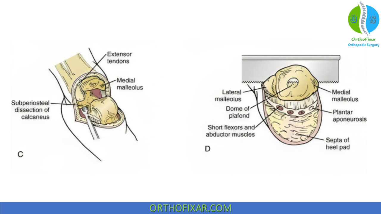 Syme Amputation & Prosthesis Easily Step-By-Step | OrthoFixar