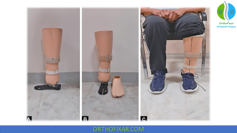 Syme Amputation & Prosthesis Easily Step-By-Step | OrthoFixar