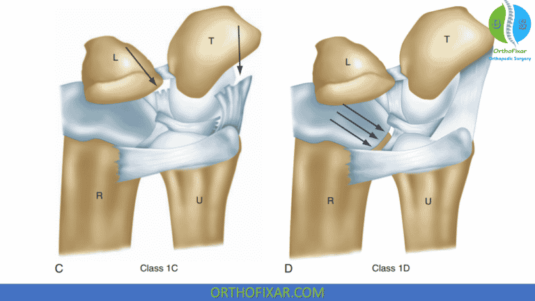 Triangular Fibrocartilage Complex Injury & Treatment | 2025