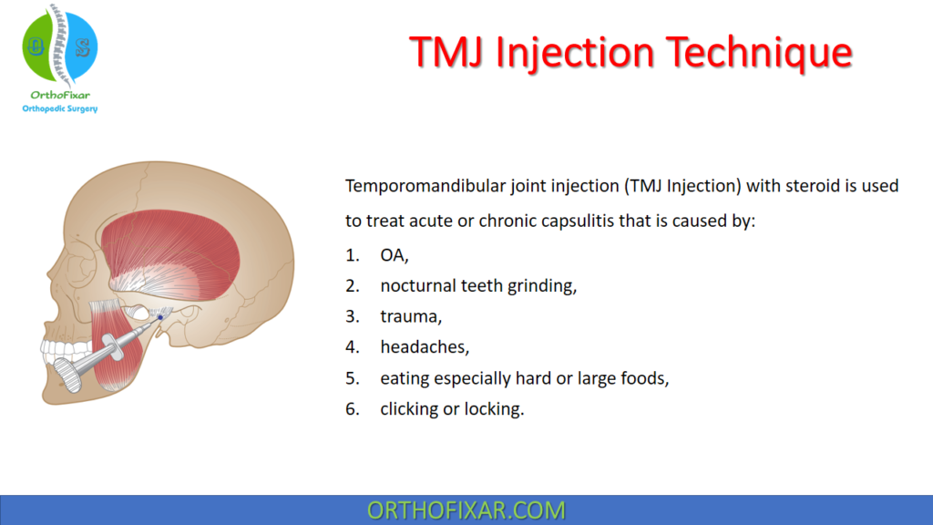 TMJ Injection Technique Easily Step-By-Step | OrthoFixar