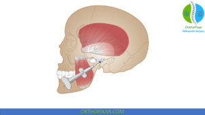 TMJ Injection Technique