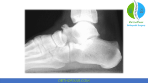 Tarsal Coalition - Easy Explained | OrthoFixar 2025