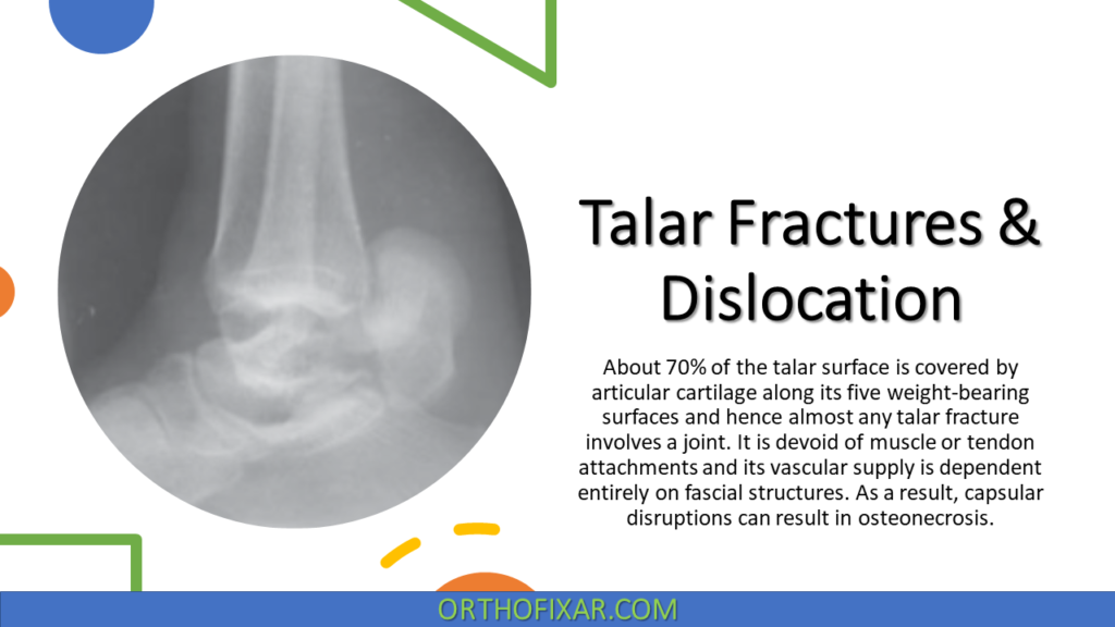 Talar Fractures & Dislocation | OrthoFixar 2025