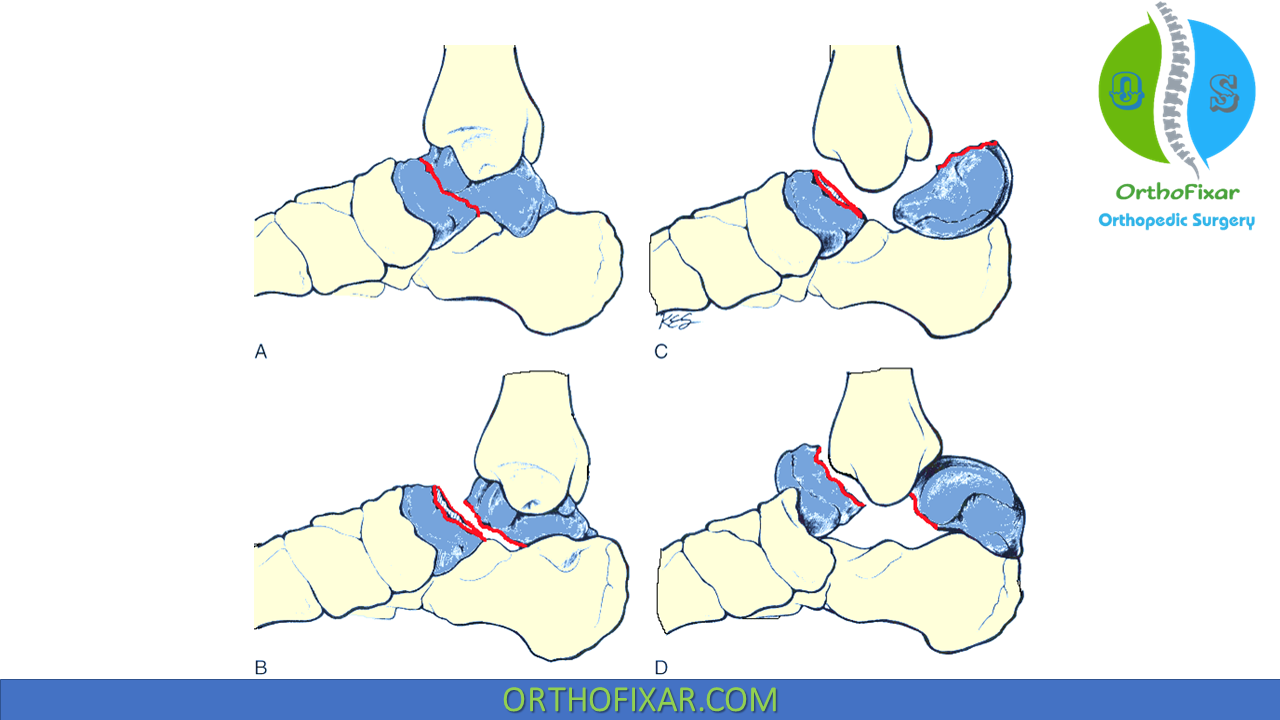 Talar Fractures & Dislocation | OrthoFixar 2025