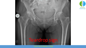 Hip Joint X-Ray Imaging | OrthoFixar