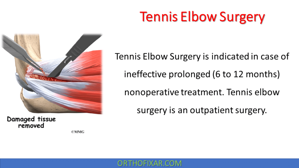 Tennis Elbow Surgery Easily Step-By-Step | OrthoFixar