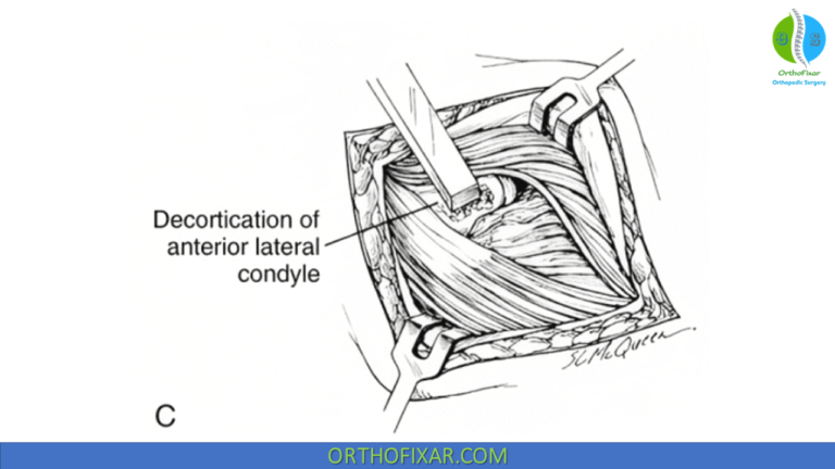 Tennis Elbow Surgery Easily Step-By-Step | OrthoFixar