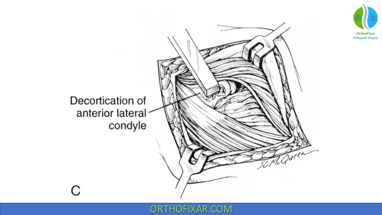 Tennis Elbow Surgery Easily Step-By-Step | OrthoFixar