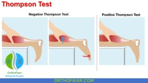 Thompson Test • Easy Explained | OrthoFixar 2026