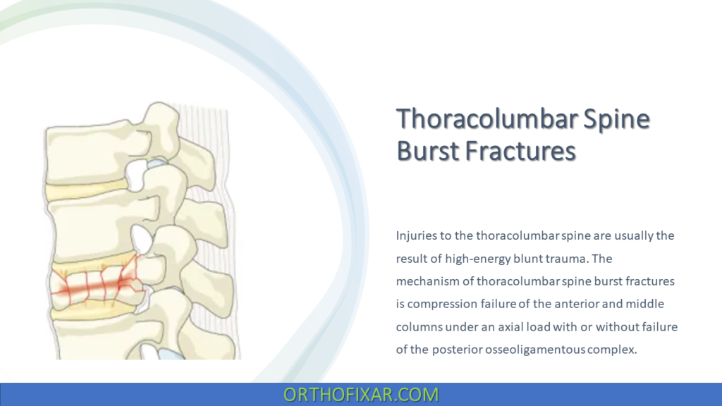 Thoracolumbar Spine Burst Fractures | OrthoFixar