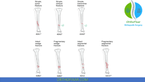 Tibia Fractures | OrthoFixar
