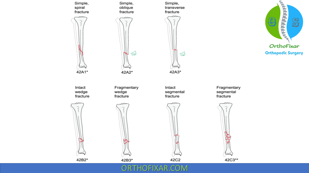 Tibia Fractures | OrthoFixar 2025 Tibia Fractures | OrthoFixar 2025