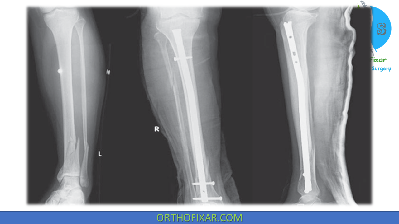 Tibia Fractures | OrthoFixar