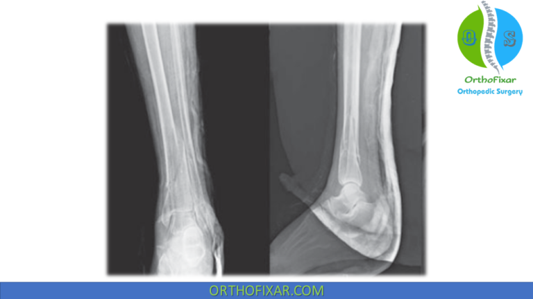Tibia Fractures | OrthoFixar