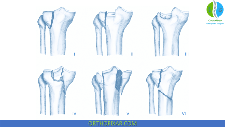 Tibial Plateau Fracture | OrthoFixar