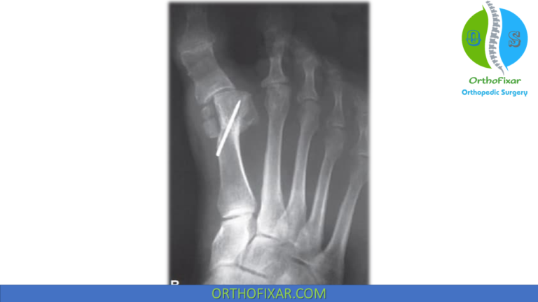 Hallux Varus - Easy Explained | OrthoFixar 2026