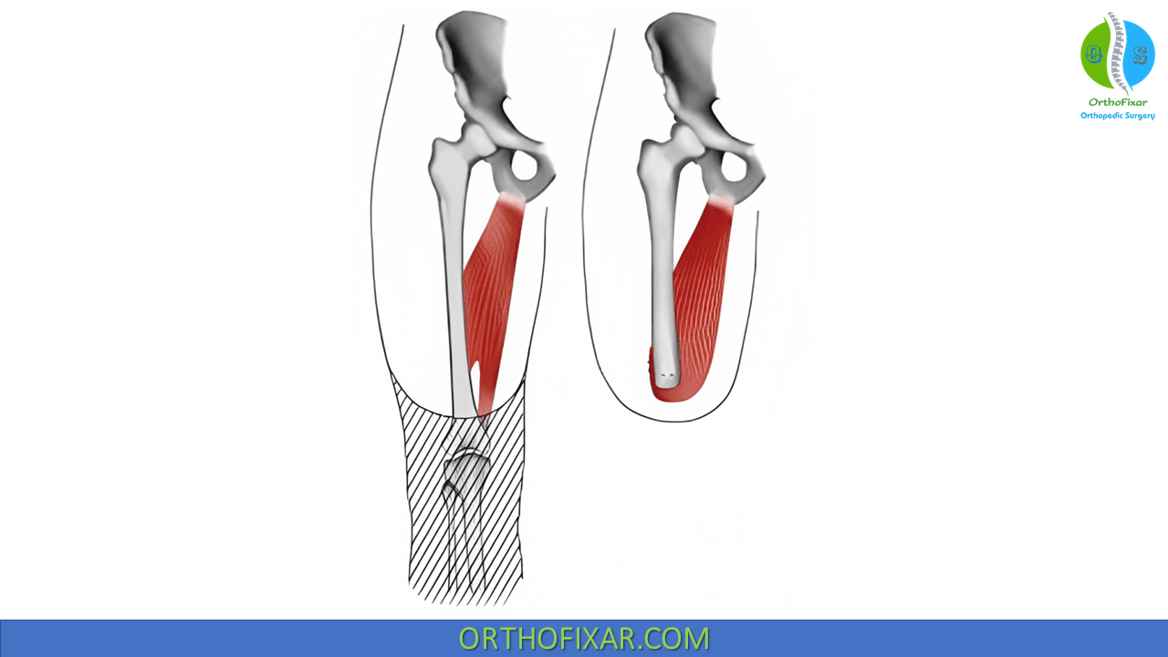 Transfemoral Amputation Easily Step-By-Step | OrthoFixar