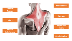 Trapezius Muscle Pain | OrthoFixar