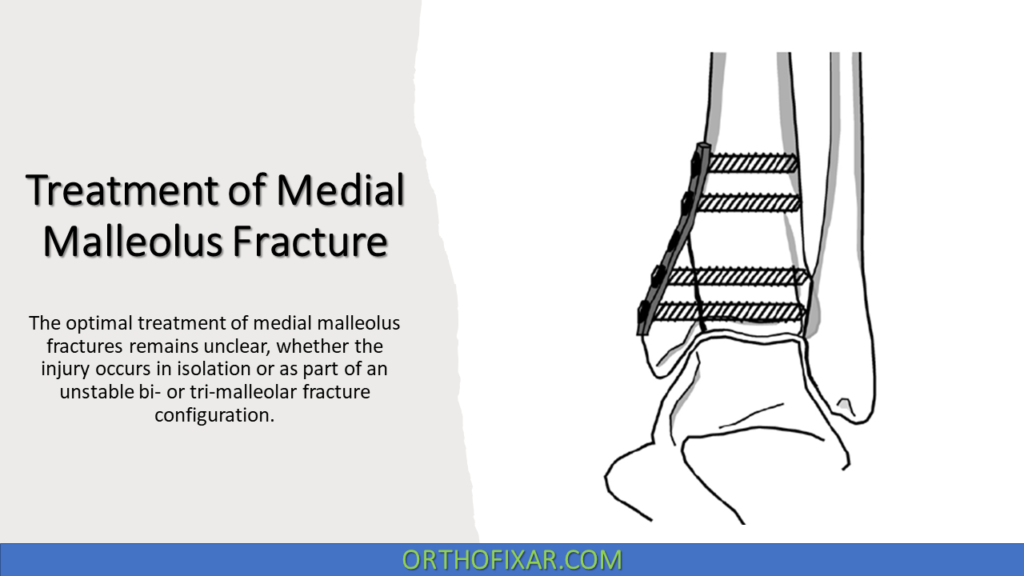 Treatment Of Medial Malleolus Fracture Easily Step-By-Step | OrthoFixar