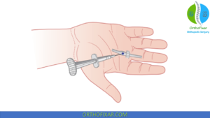 Trigger Finger Injection Easily Step-By-Step | OrthoFixar