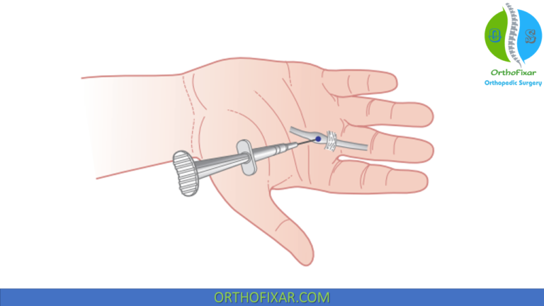 Trigger Finger Injection Easily Step-By-Step | OrthoFixar