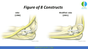 Elbow UCL Repair Surgery Easily Step-By-Step | OrthoFixar