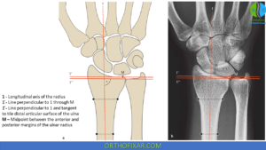 Ulnar Variance | OrthoFixar 2023