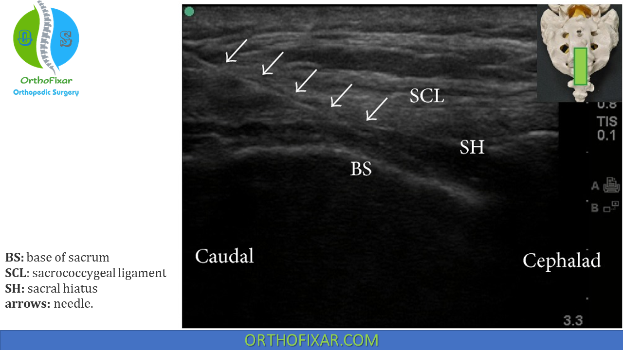 Caudal Epidural Injection Overview | OrthoFixar 2025