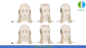 Head Impulse Test