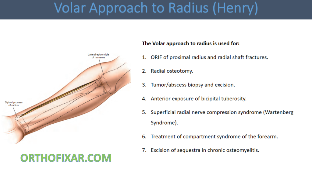 Volar Approach To Radius Easy Tutorial | OrthoFixar 2025