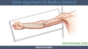 Volar Approach To Radius Easy Tutorial | OrthoFixar 2025