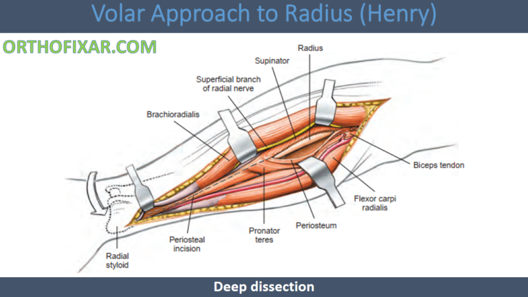 Volar Approach To Radius Easy Tutorial | OrthoFixar 2026