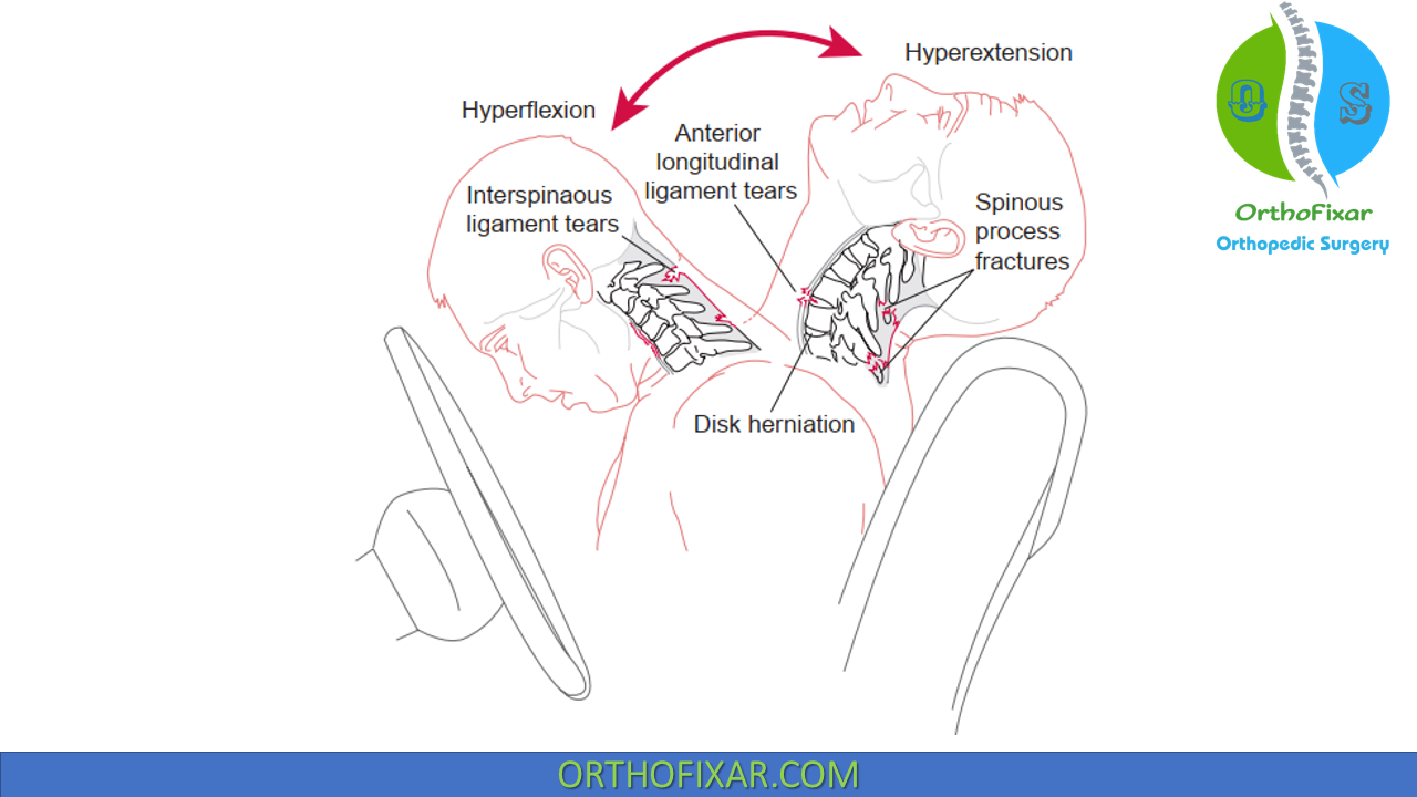 Whiplash Injury Diagnosis, Symptoms & Treatment | 2025