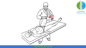 Wilson Test Overview - Easy Explained | OrthoFixar 2025