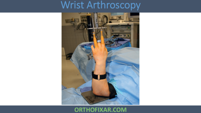 Wrist Arthroscopy • Easy Tutorial • OrthoFixar 2026