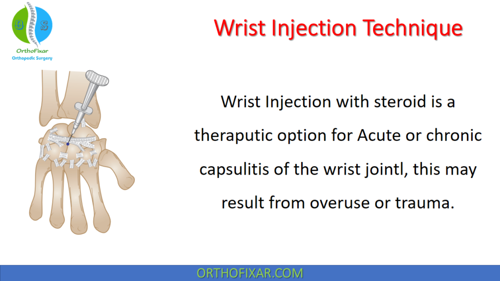 Wrist Injection Technique Easily Step-By-Step | OrthoFixar